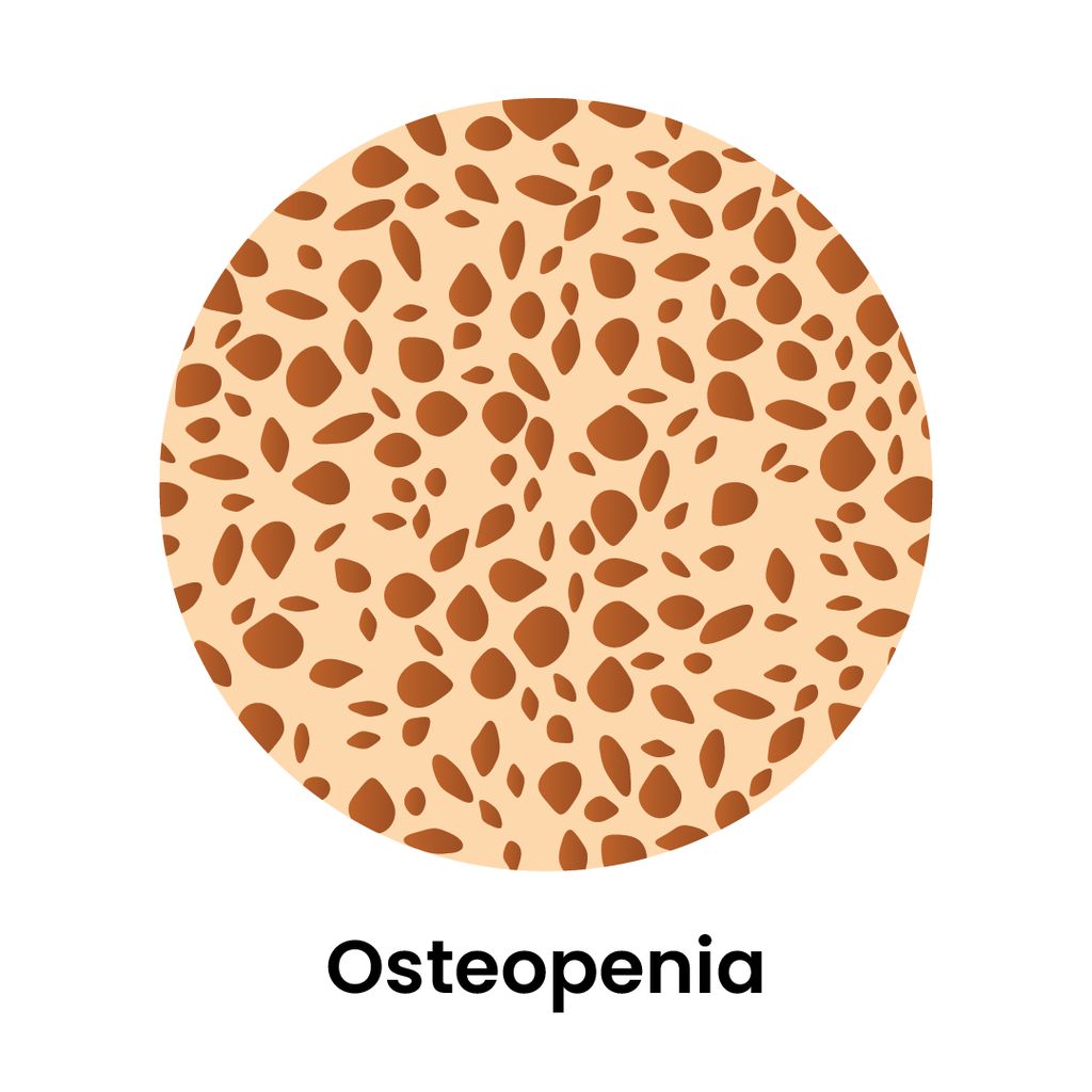 Osteoporosis and Osteopenia - The Perfect Workout®