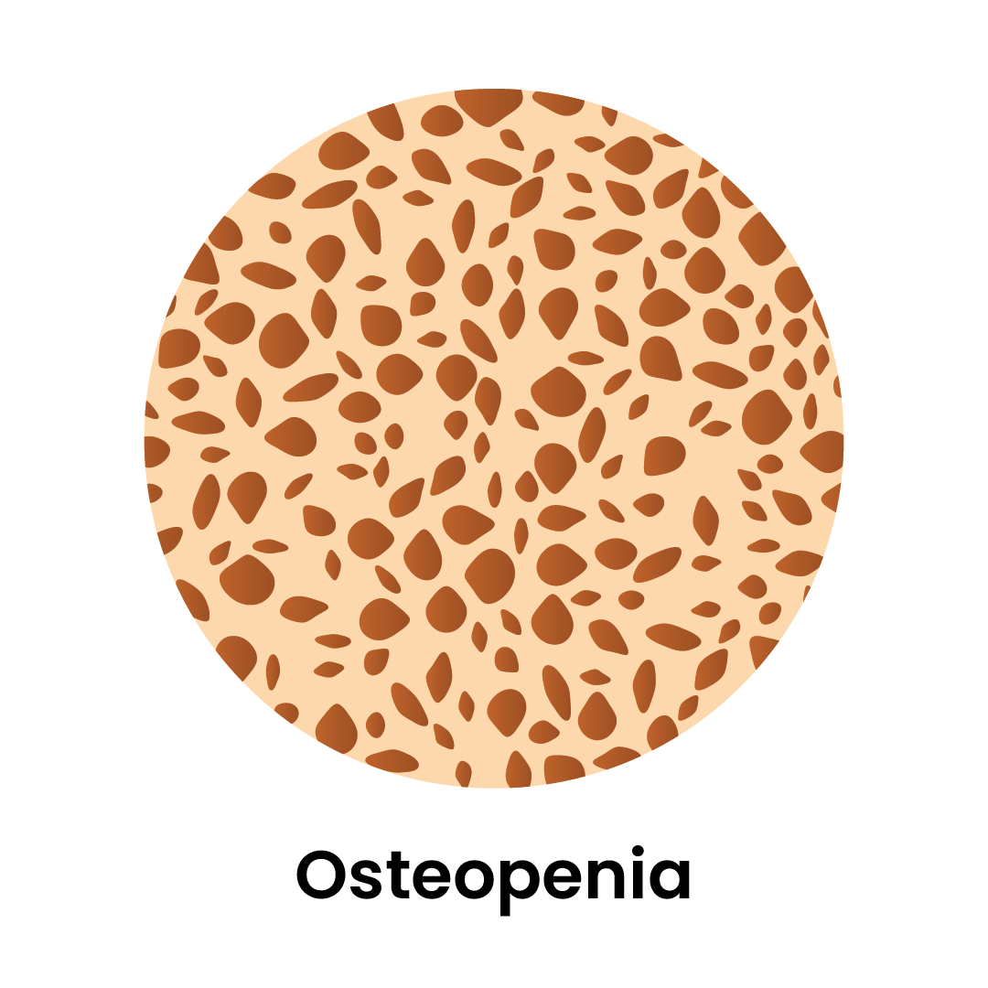 Osteoporosis and Osteopenia - The Perfect Workout